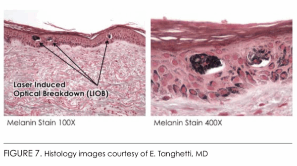 PicoSure Laser Singapore | Advanced Skin Rejuvenation