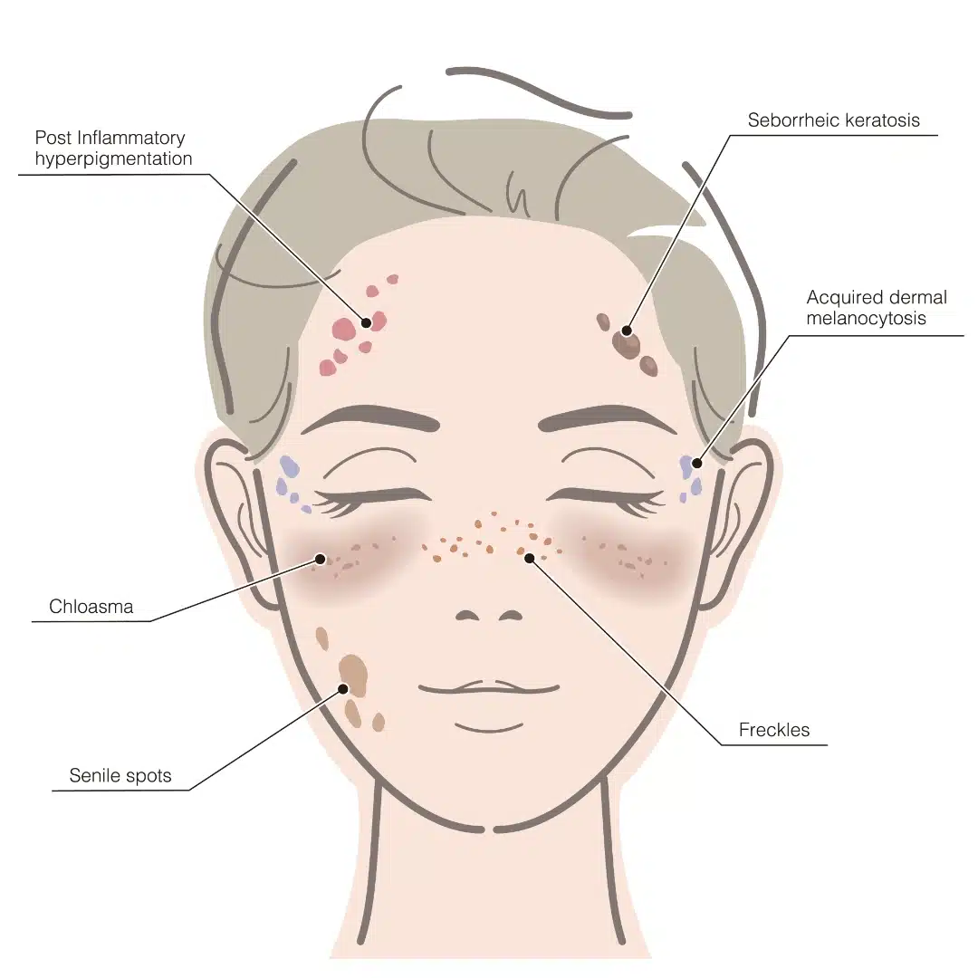 Melasma Pigmentation: Causes, Treatments, and Results