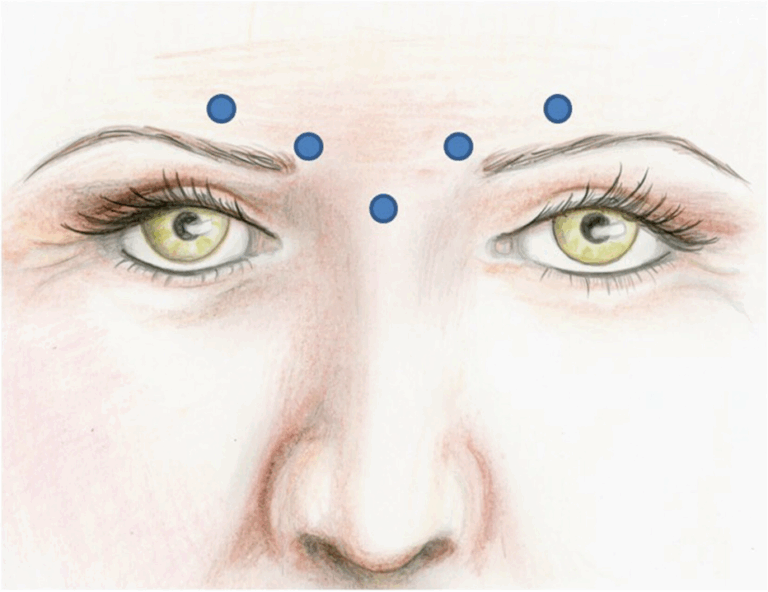 Botox for Frown Lines (Glabellar) | Bay Aesthetics Singapore
